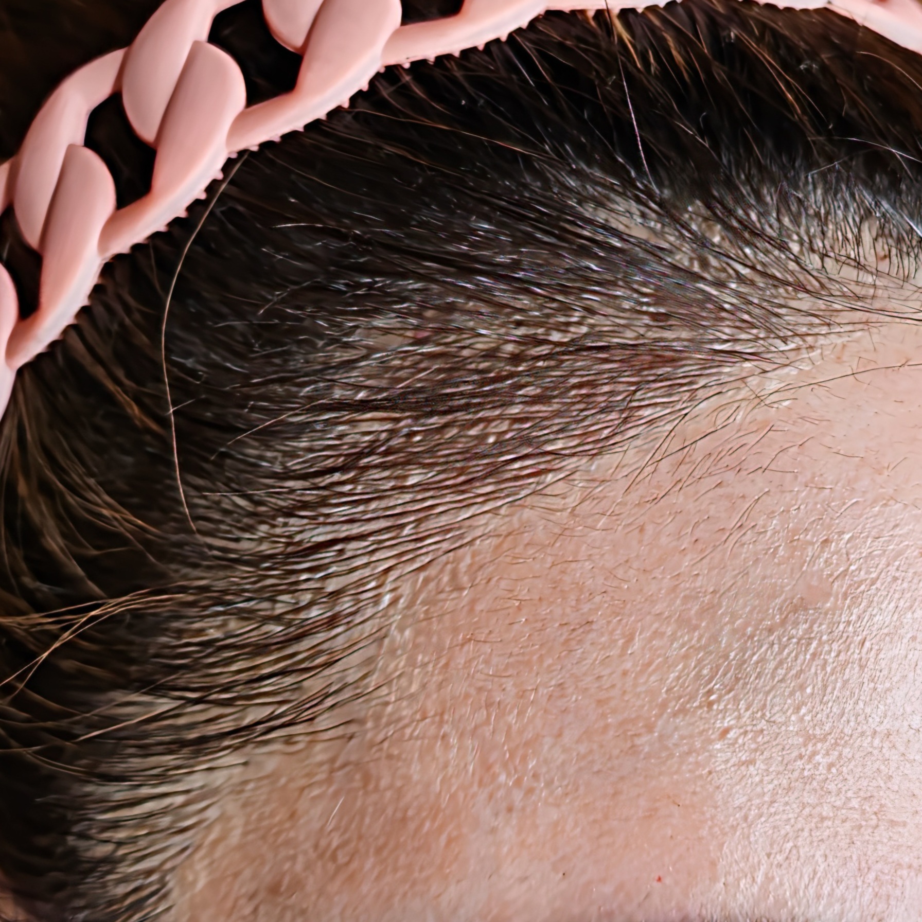 Hawaii Hairline Restoration PMU - Korean Style - Hawaii Beauty Studio